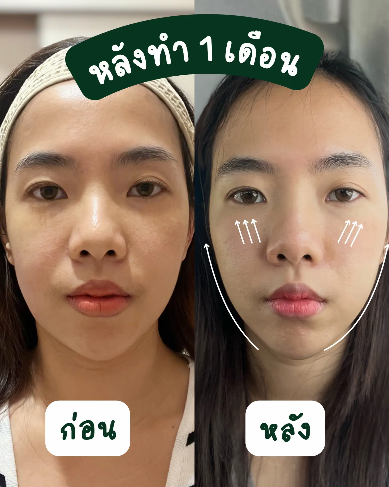 รีวิว Ultramax Hifu - การค้นหาใน Lemon8