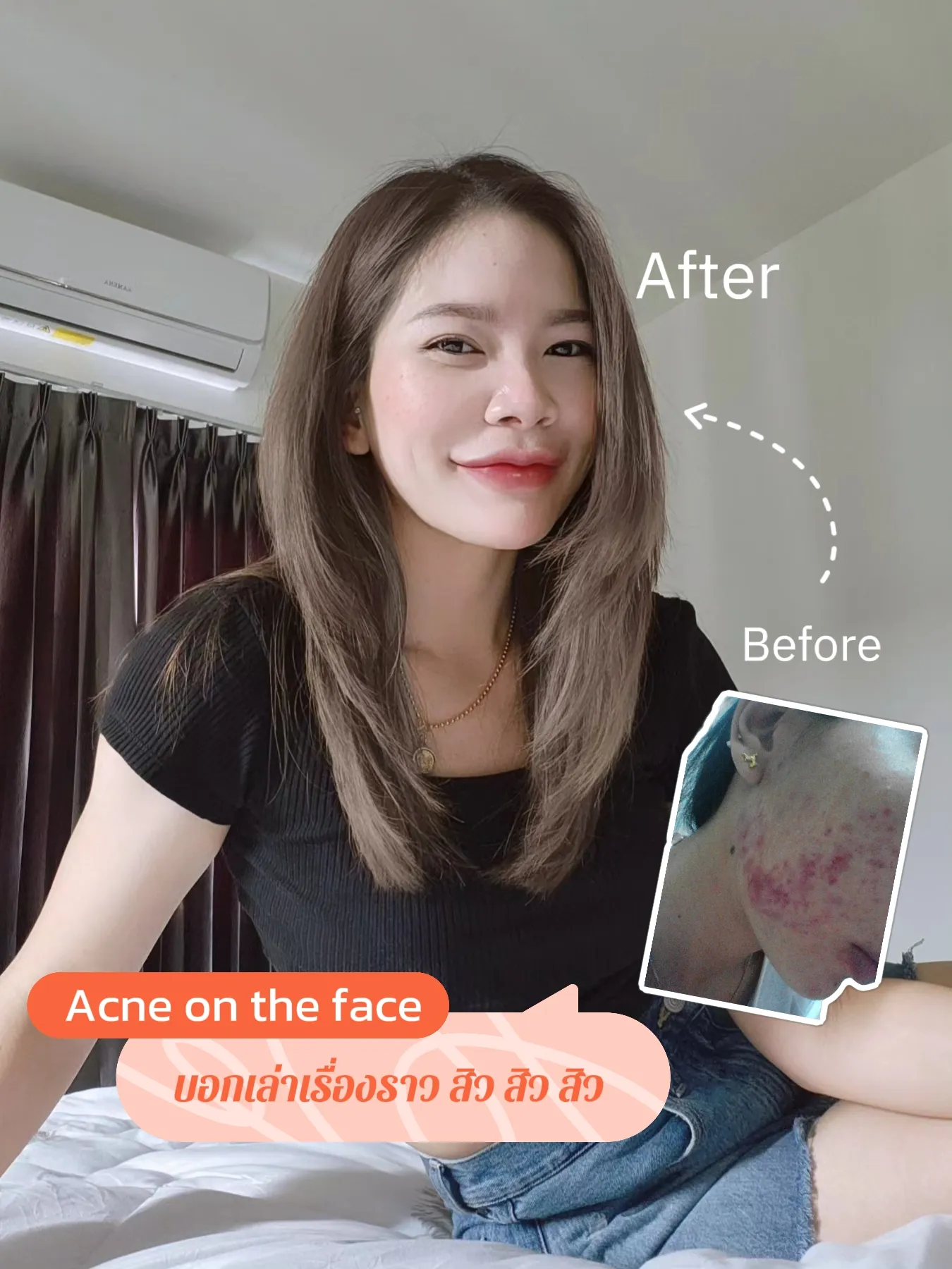 Acne on the face 💣 | แกลเลอรีที่โพสต์โดย APICHAYA S. | Lemon8