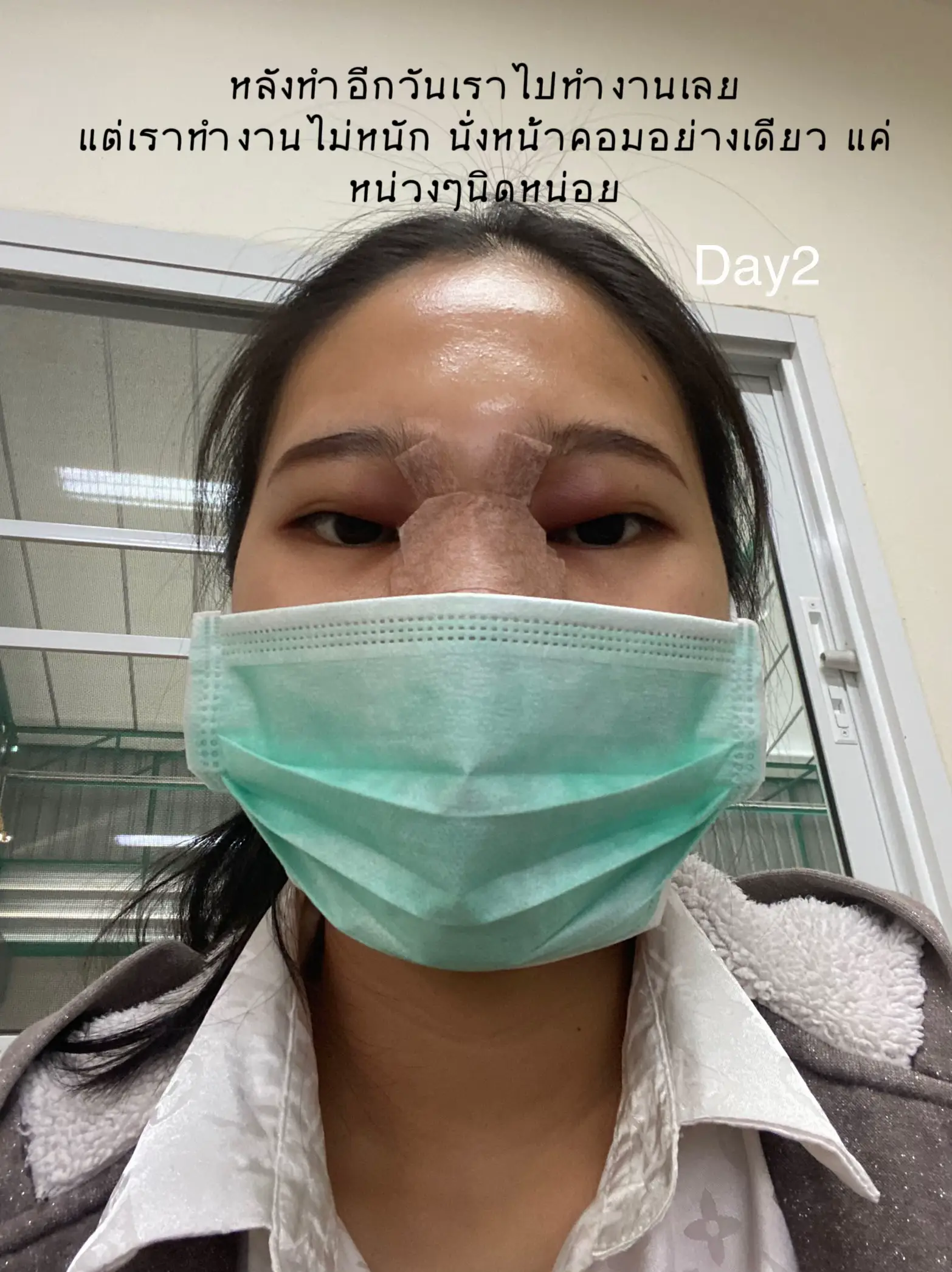 ประสบการณ์ทำจมูกครั้งแรก👃🏻 | แกลเลอรีที่โพสต์โดย Yns. | Lemon8