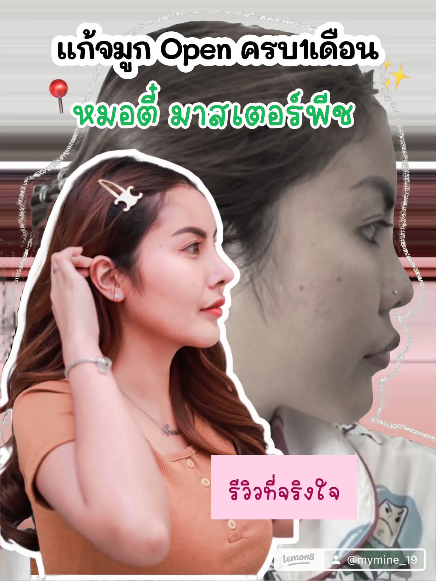 ตะหมูกใหม่ครบ 1 เดือน👃🏻 | แกลเลอรีที่โพสต์โดย Mine | Lemon8