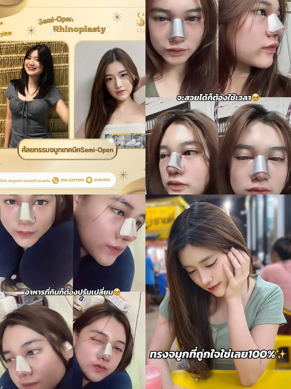 👃🏻เสริมจมูกเสริมใหม่👃🏻 สโล | แกลเลอรีที่โพสต์โดย SBclinic_kk | Lemon8