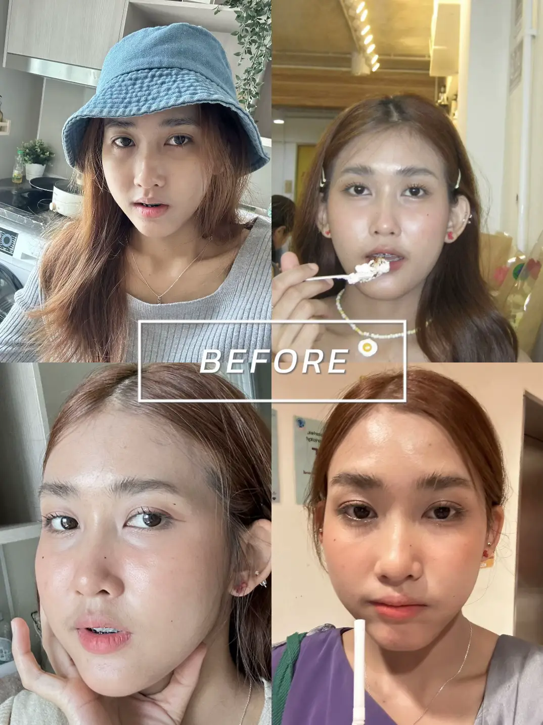 รีวิวฉีดใต้ตา Lbc - การค้นหาใน Lemon8