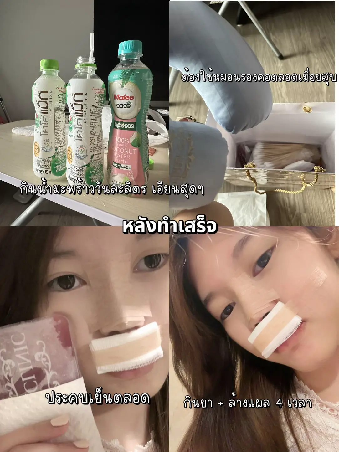 เสริมจมูกครั้งแรกในชีวิต ไม่เหมือนอย่างที่คิด? | แกลเลอรีที่โพสต์โดย Ms ...