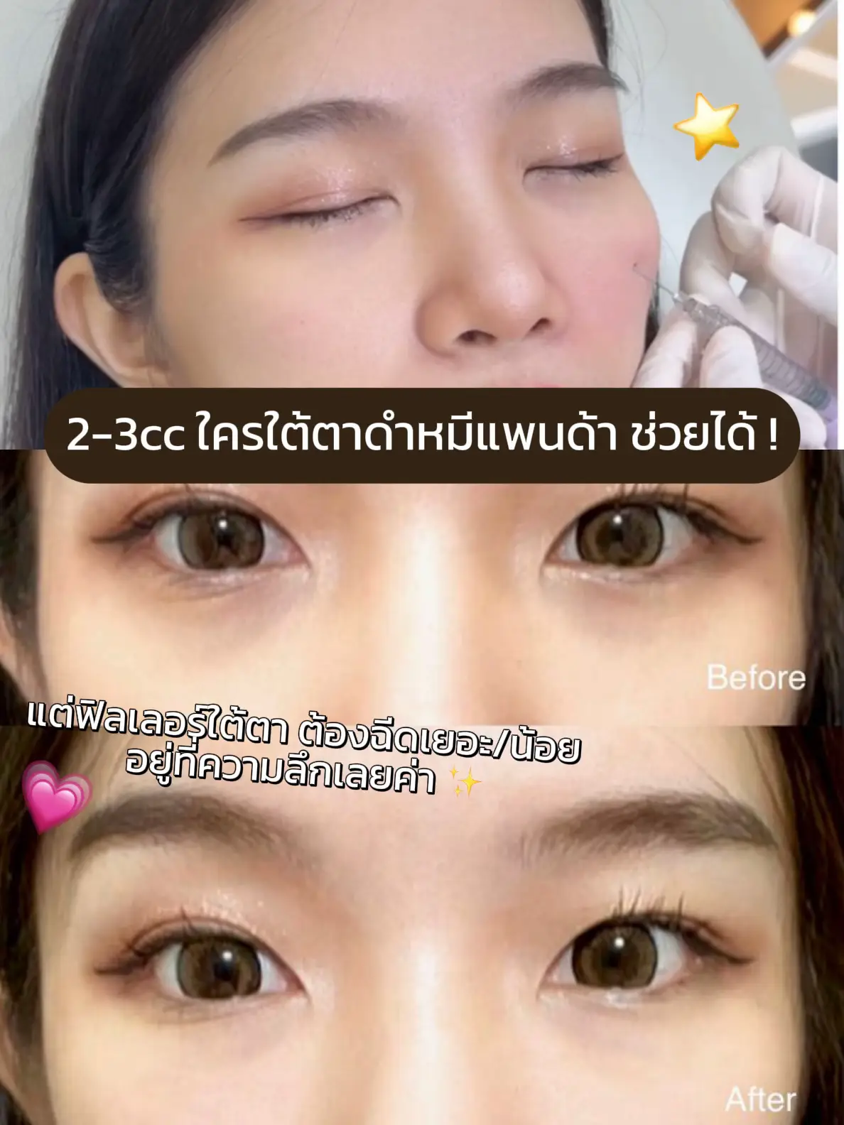 เซฟด่วน ‼️ ตัวแม่จะมาตอบจ้าา ฉีด Filler ตรงไหนต้องจิ้มกี่ CC | แกลเลอรีที่โพสต์โดย ฮลม.ชอบรีวิว🪄 ...