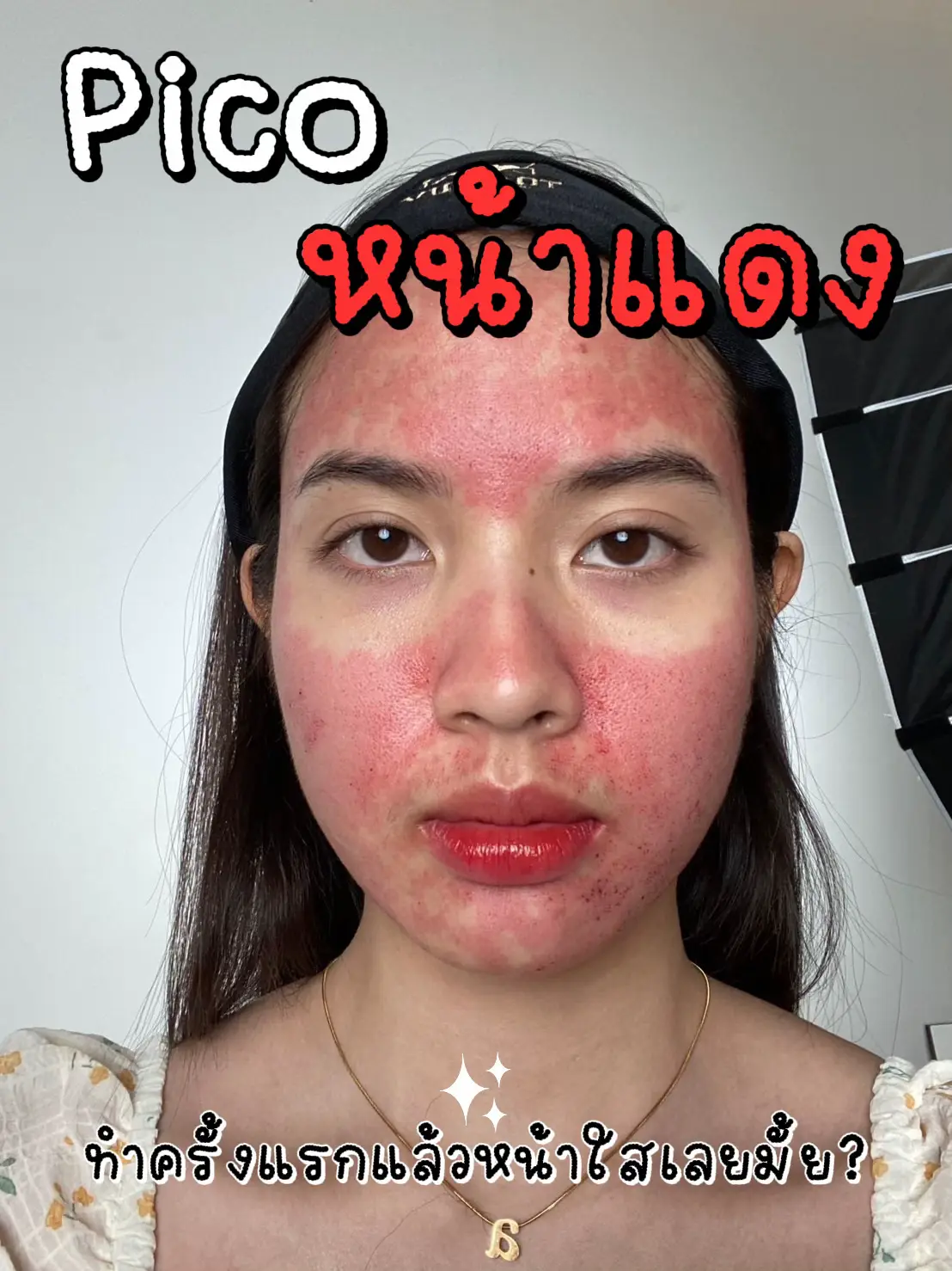 Pico หน้าแดง ทำครั้งแรกหน้าใสเลยมั้ย!? | แกลเลอรีที่โพสต์โดย วินเซนต์พารีวิว | Lemon8