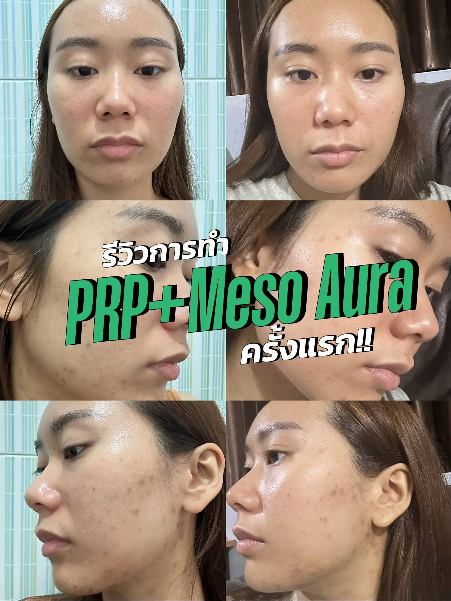 PRP+Meso Aura ครั้งแรกแบบคนมีรอยสิวเยอะ แพ้ง่าย!! | แกลเลอรีที่โพสต์โดย ...