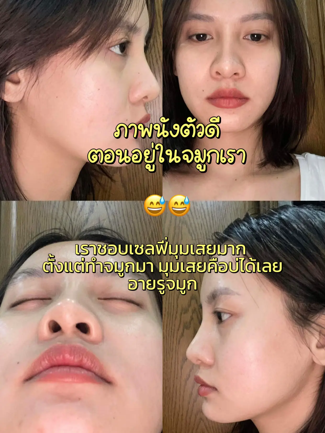แชร์ประสบการณ์ถอดซิลิโคนจมูก 📌 | แกลเลอรีที่โพสต์โดย Phichawee Arun | Lemon8