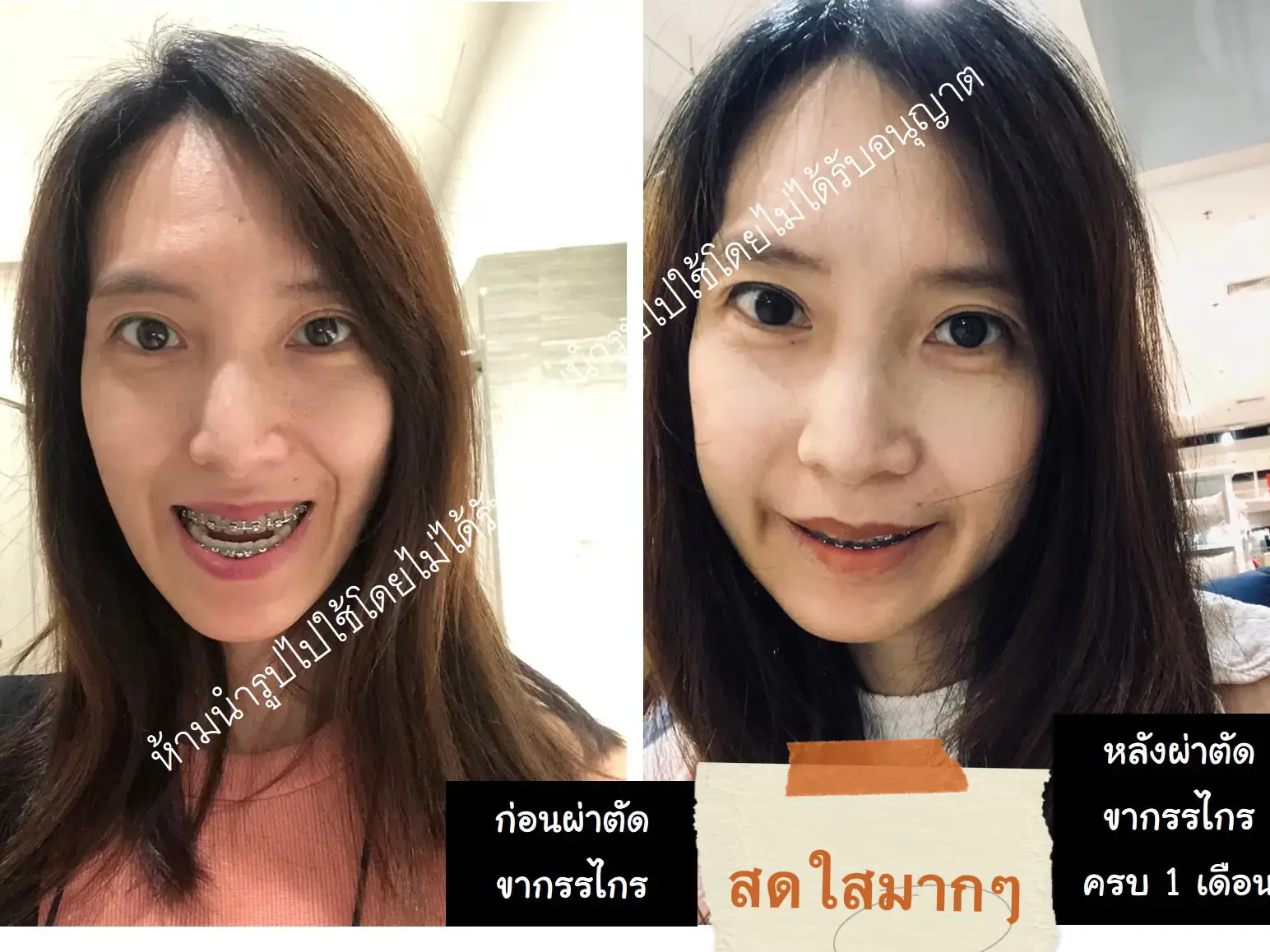 Ep.3、顎の手術2ヶ月。どれどれ。 | PpSAmEが投稿したフォトブック | Lemon8