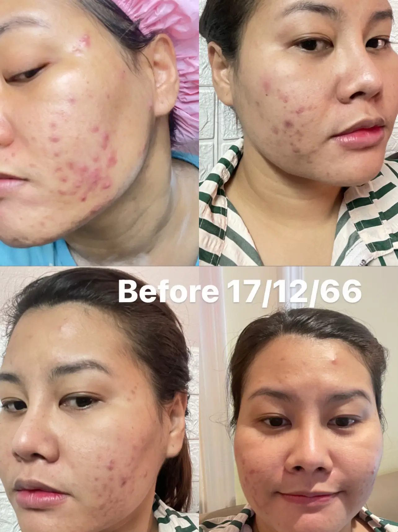 Ep.1. รักษาสิวครั้งแรก @พรเกษมคลีนิค | แกลเลอรีที่โพสต์โดย Mm.mee NRKL | Lemon8