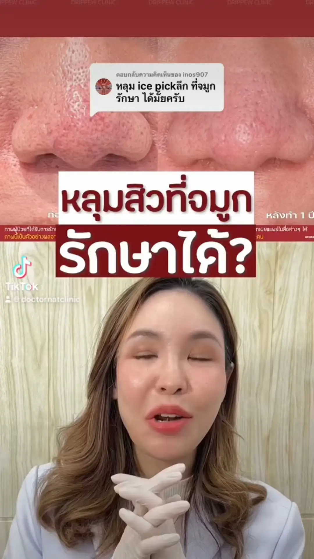 หลุมที่จมูก รักษาได้? | วิดีโอที่เผยแพร่โดย Dr.Nat Clinic | Lemon8