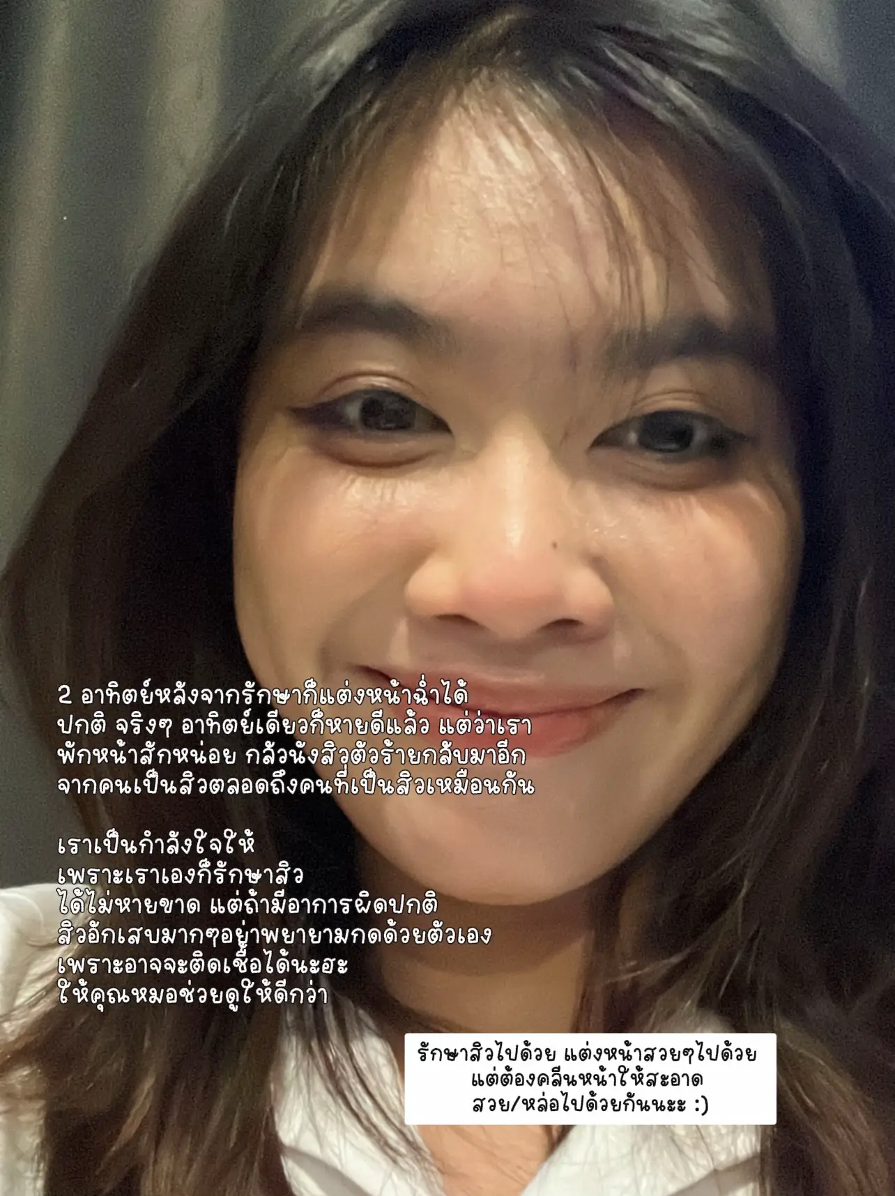 เป็นสิวซีสต์!! ทำไงดี หน้าจะเป็นหลุมไหม | แกลเลอรีที่โพสต์โดย Wanatthanun Puk | Lemon8