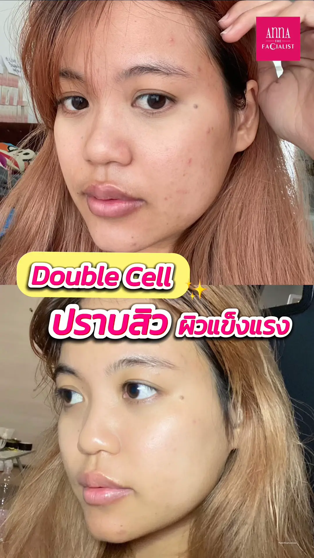 Double Cell โปรแกรมปราบสิว🥰 | วิดีโอที่เผยแพร่โดย annaclinic | Lemon8