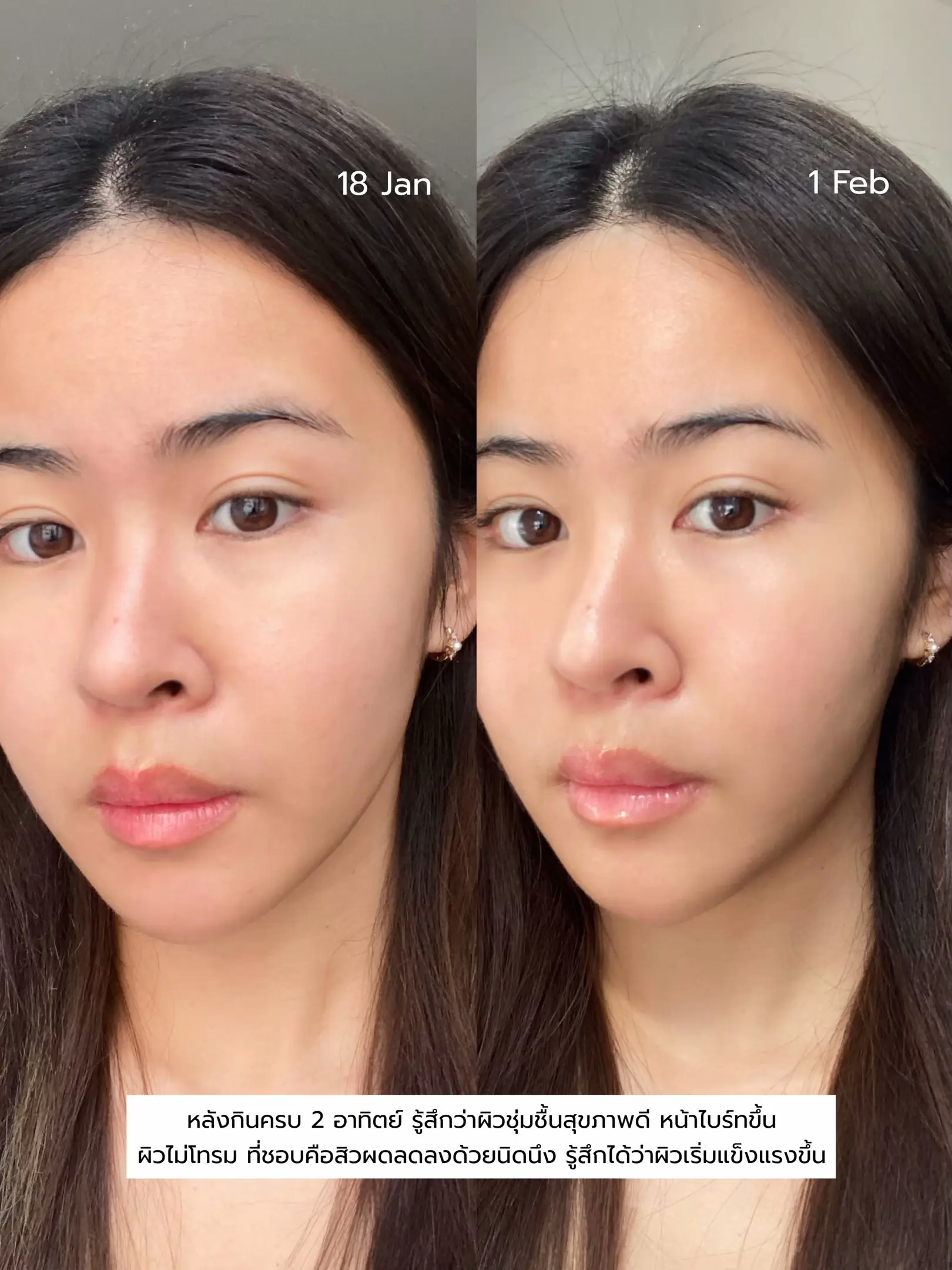 รีวิว 111SKIN วิตามินแพงสุดในชีวิต ️หลังกินมา2week คุ้มมั้ย? | แกลเลอรีที่โพสต์โดย ...