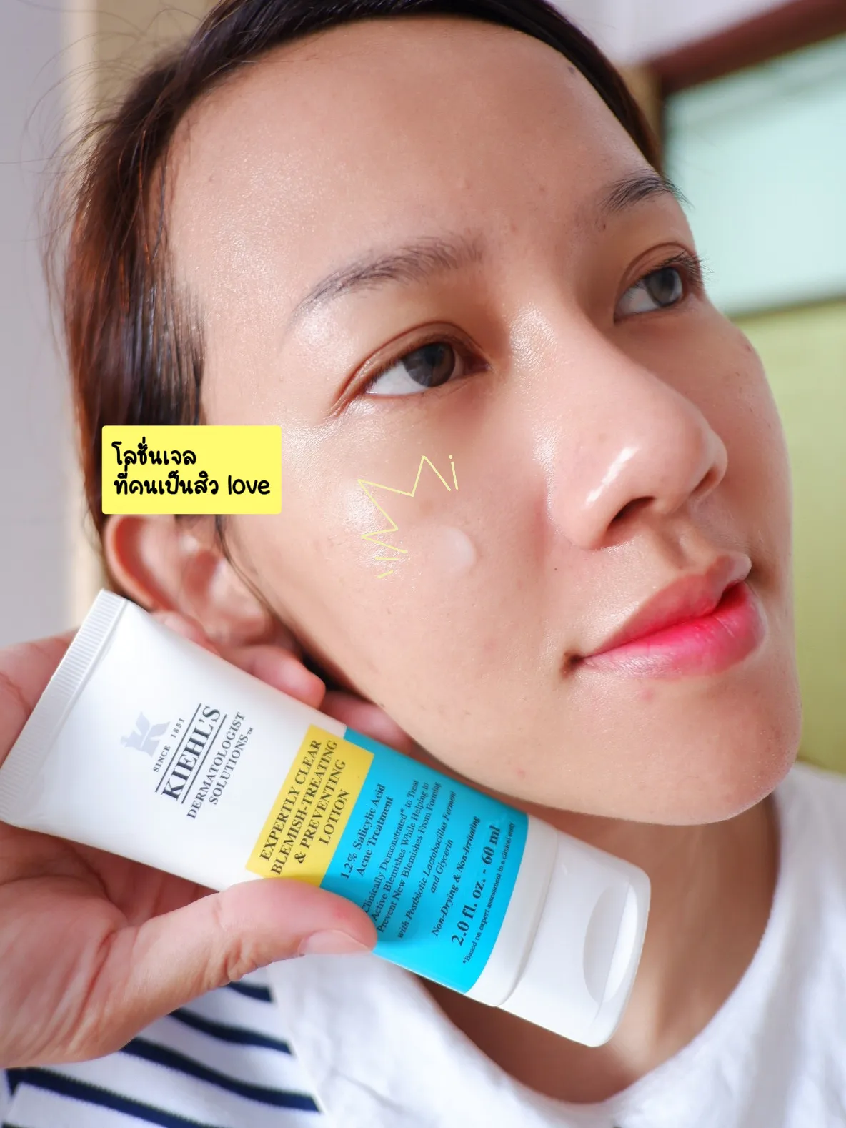 New..!! โลชั่นเจลกู้สิว ให้ปัญหาสิวเป็นเรื่องจิ๋วๆ | แกลเลอรีที่โพสต์โดย Numsom Araya | Lemon8