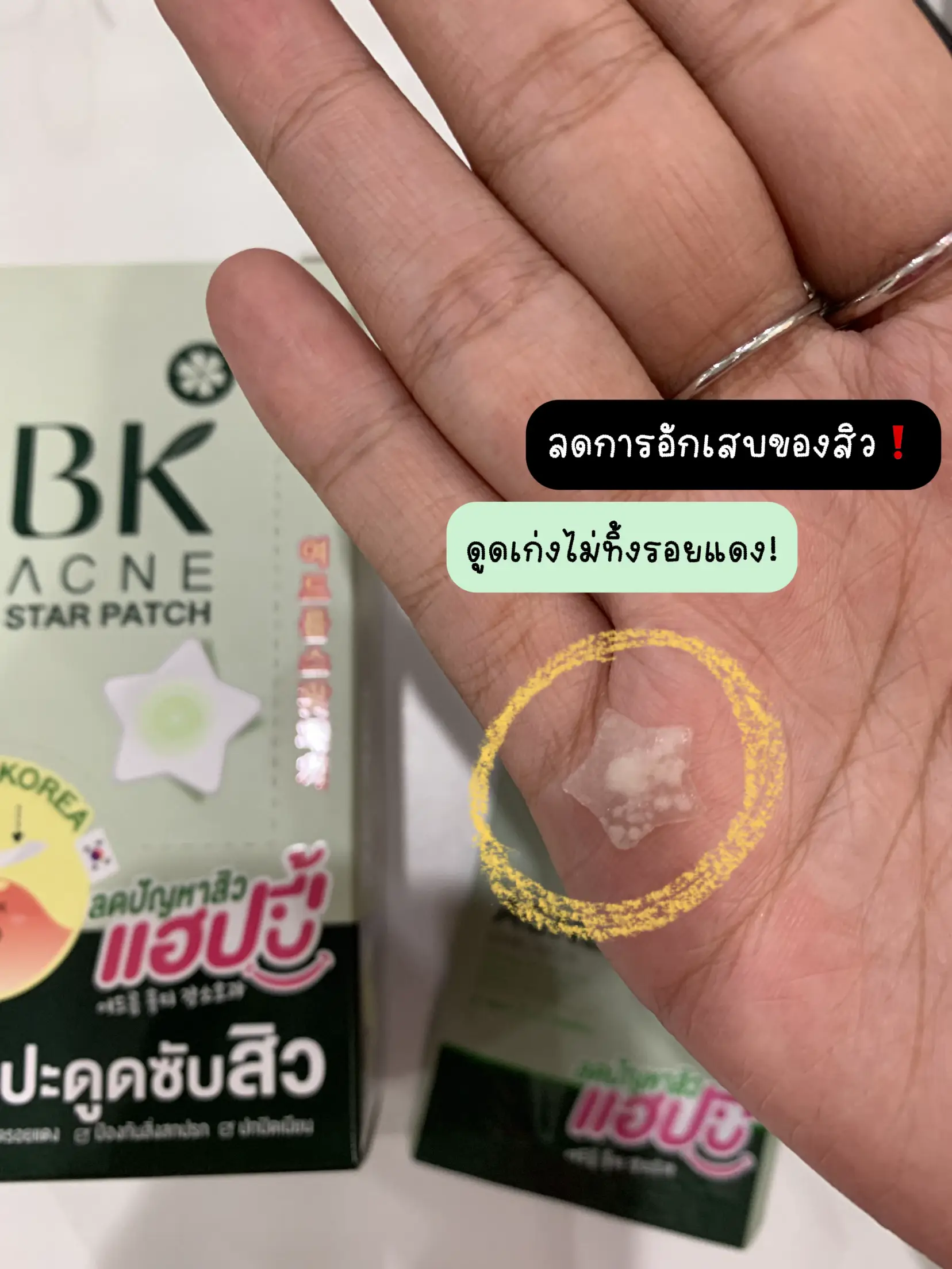 แผ่นแปะสิว BK Acneดูดเก่งไม่ทิ้งรอยแดงจริงไหม? | แกลเลอรีที่โพสต์โดย M ヅ | Lemon8