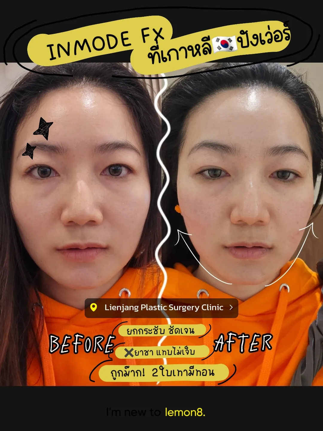 INMODE Fx ที่เกาหลี🇰🇷 ไม่ถึง 2 ใบเทา | แกลเลอรีที่โพสต์โดย Pearllii🐚🔮 ...