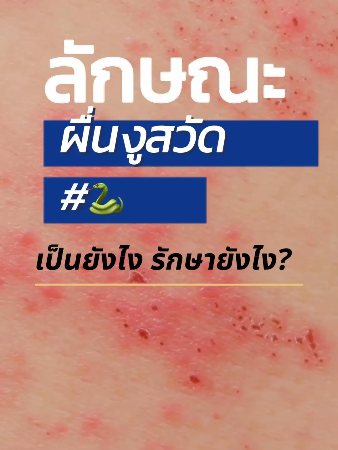 📢รู้ทันหายไว ผื่นงูสวัด⁉️ (Shingles)🐍 | วิดีโอที่เผยแพร่โดย Dr.Pop | Lemon8