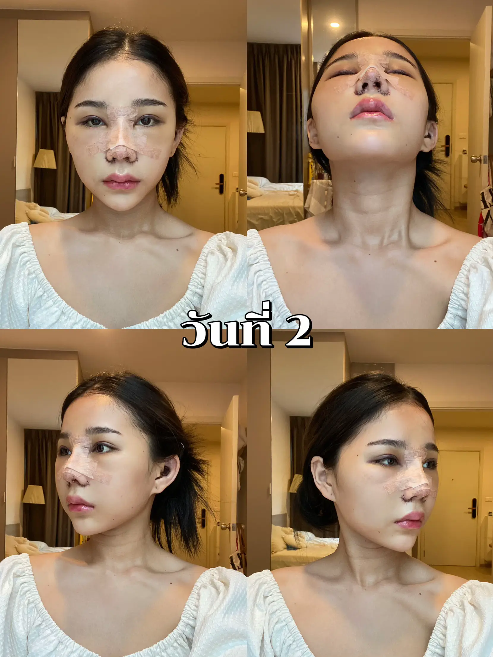 ศัลยกรรมครั้งแรกในชีวิต ปังหรือพัง ‼️ | แกลเลอรีที่โพสต์โดย Nu Dee🐰 | Lemon8