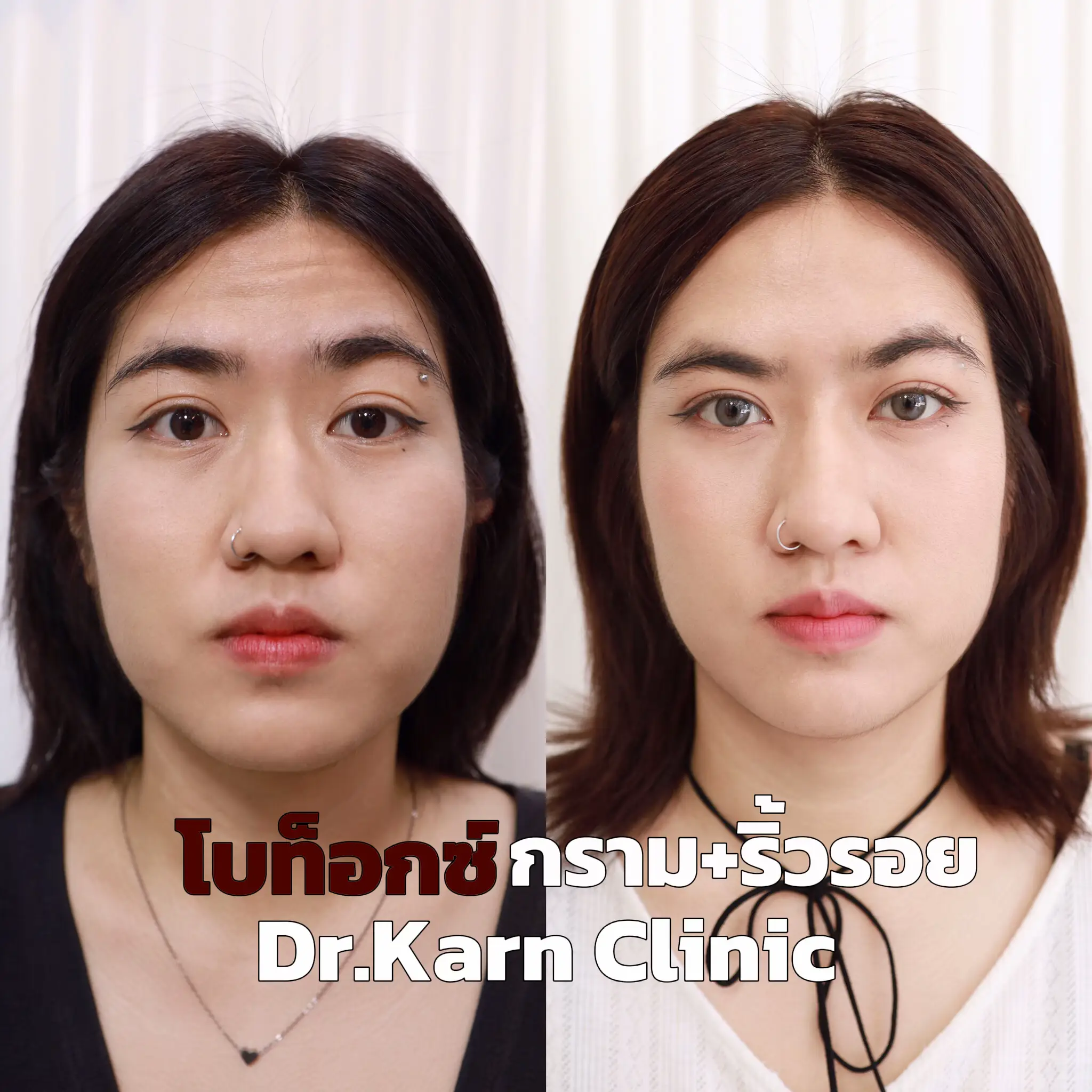 โบท็อกซ์กราม+ริ้วรอย 💕 | แกลเลอรีที่โพสต์โดย Dr.Karn Beauty | Lemon8