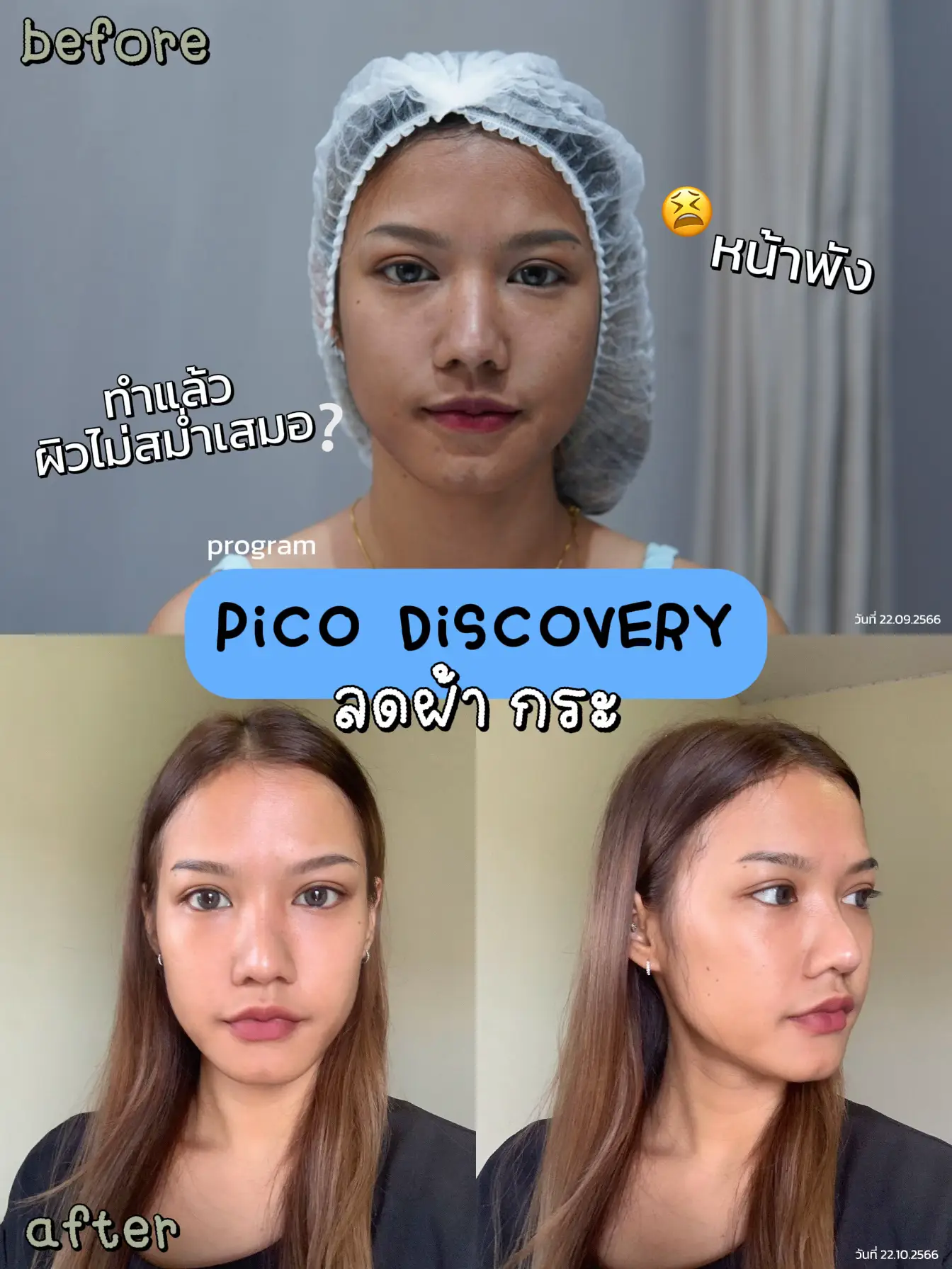 PICO Discovery ลดฝ้า กระจริงไม่จริง?! | แกลเลอรีที่โพสต์โดย wonder girl. | Lemon8
