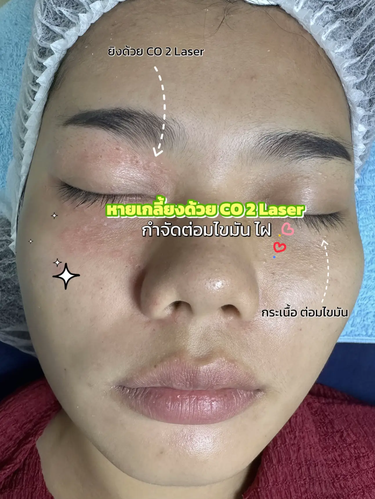 กระเนื้อ ต่อมไขมัน หายเกลี้ยงด้วย Co 2 laser 🍋 | แกลเลอรีที่โพสต์โดย Dr.Ploy รุ่งนภา | Lemon8
