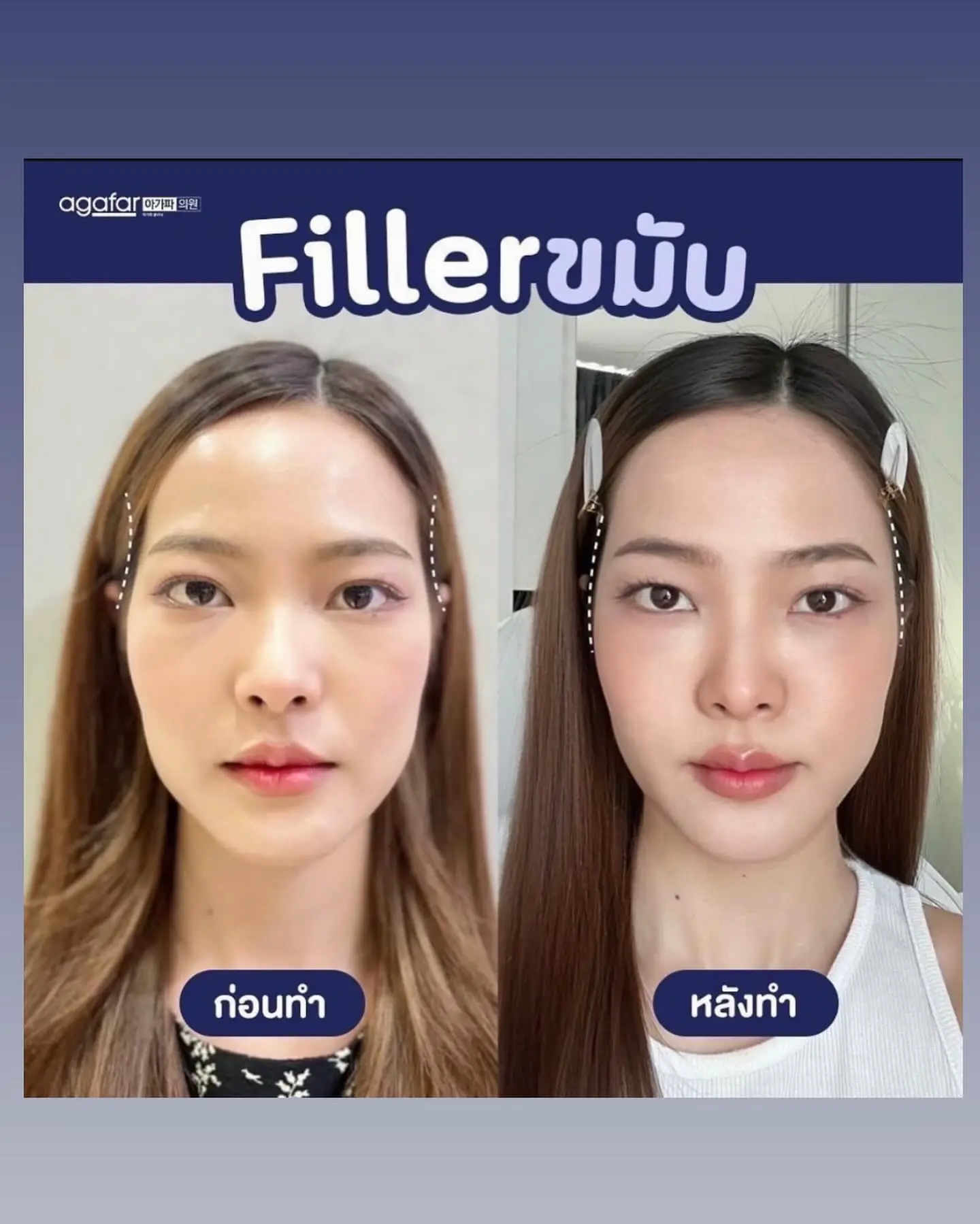 รีวิวการฉีด fillerขมับ | แกลเลอรีที่โพสต์โดย Kat Patcharin | Lemon8