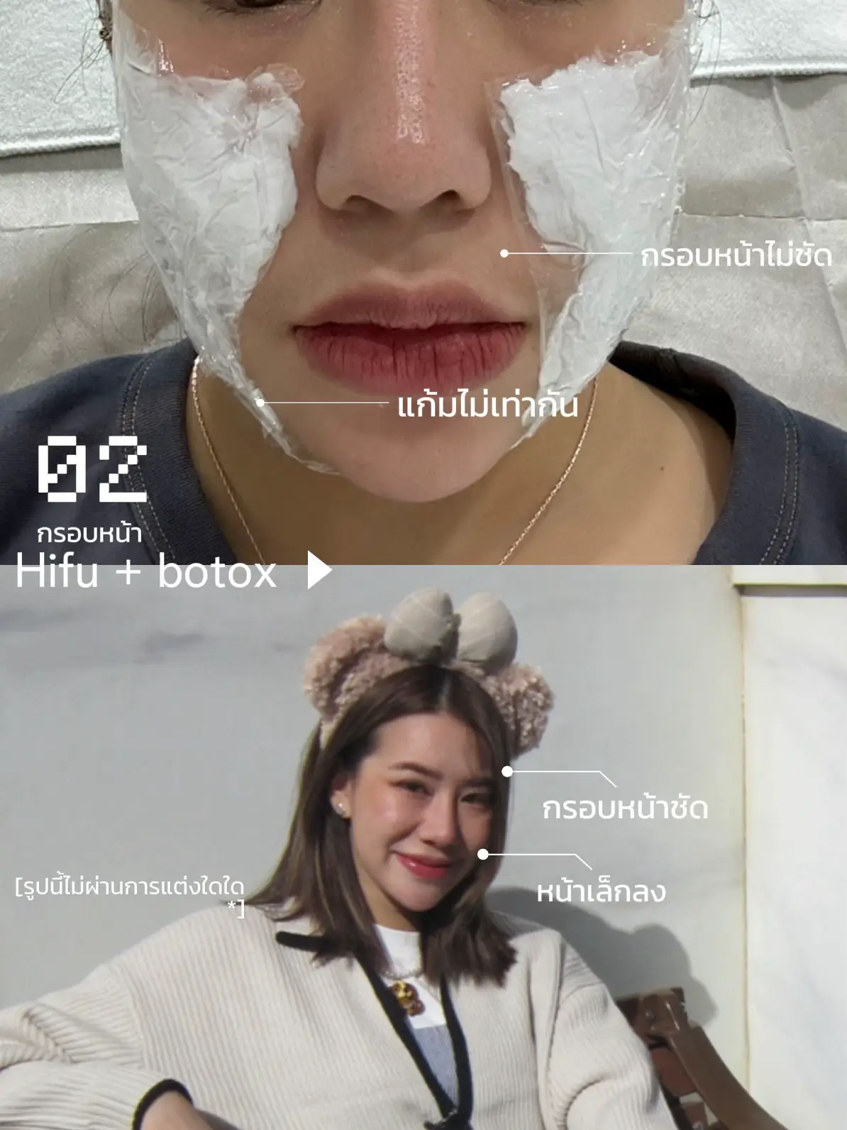 สิวขึ้นเยอะ?! คุณหมอแก้ได้ | แกลเลอรีที่โพสต์โดย punch♡ | Lemon8