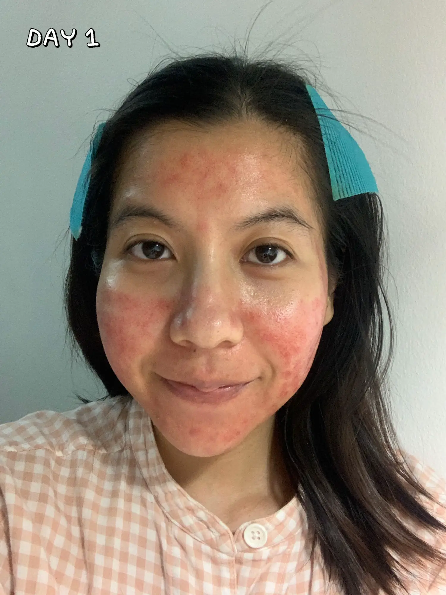 Pico laser หน้าใส @SWU skin center | แกลเลอรีที่โพสต์โดย Praewpipat ...