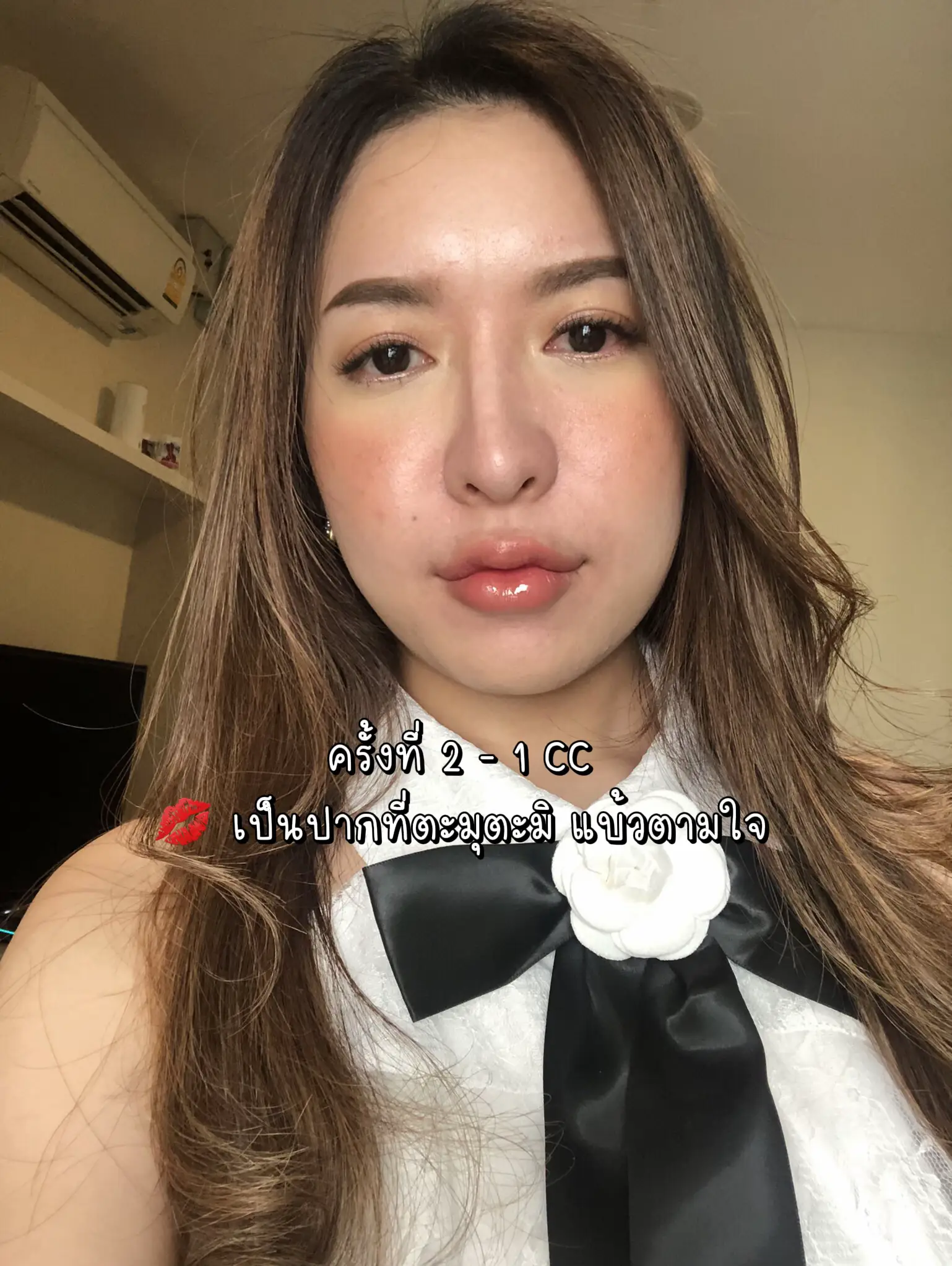 Filer ปาก ค่อยๆเติมทีละ 1 cc #ฟิลเลอร์ปาก | แกลเลอรีที่โพสต์โดย Chadadayuu | Lemon8