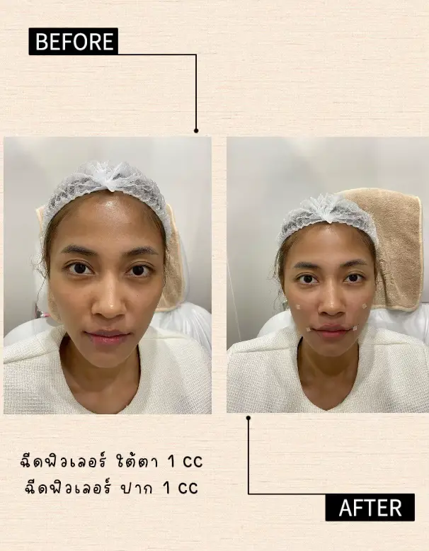 รีวิวฉีดฟิลเลอร์ใต้ตาเเละปาก ฉบับคนฉีดครั้งแรก | แกลเลอรีที่โพสต์โดย Aor Sureeporn | Lemon8