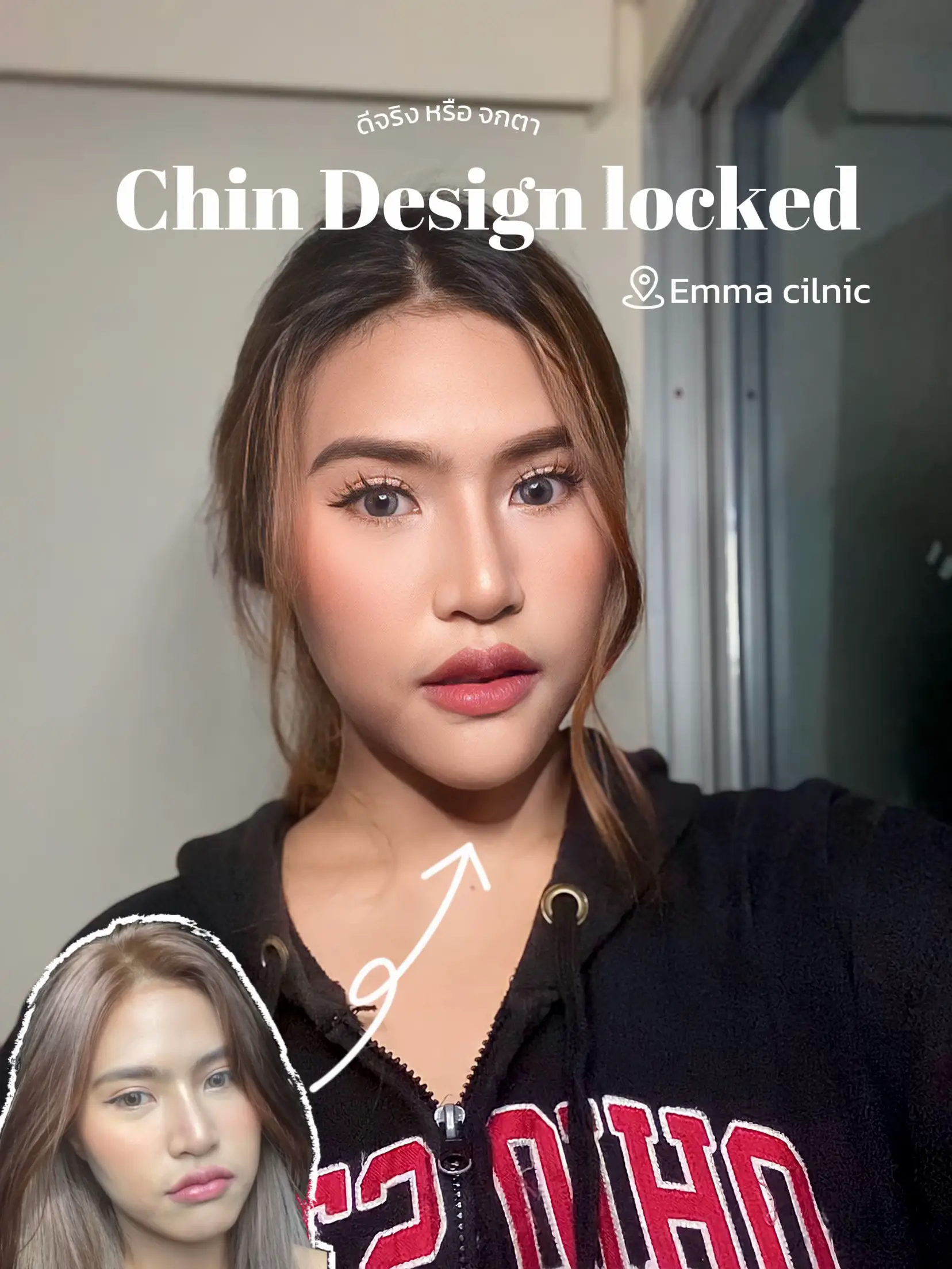 รีวิวแก้คางที่ Emma Cilnic ดีจริงหรือจกตา? | แกลเลอรีที่โพสต์โดย Jaranin Jin | Lemon8
