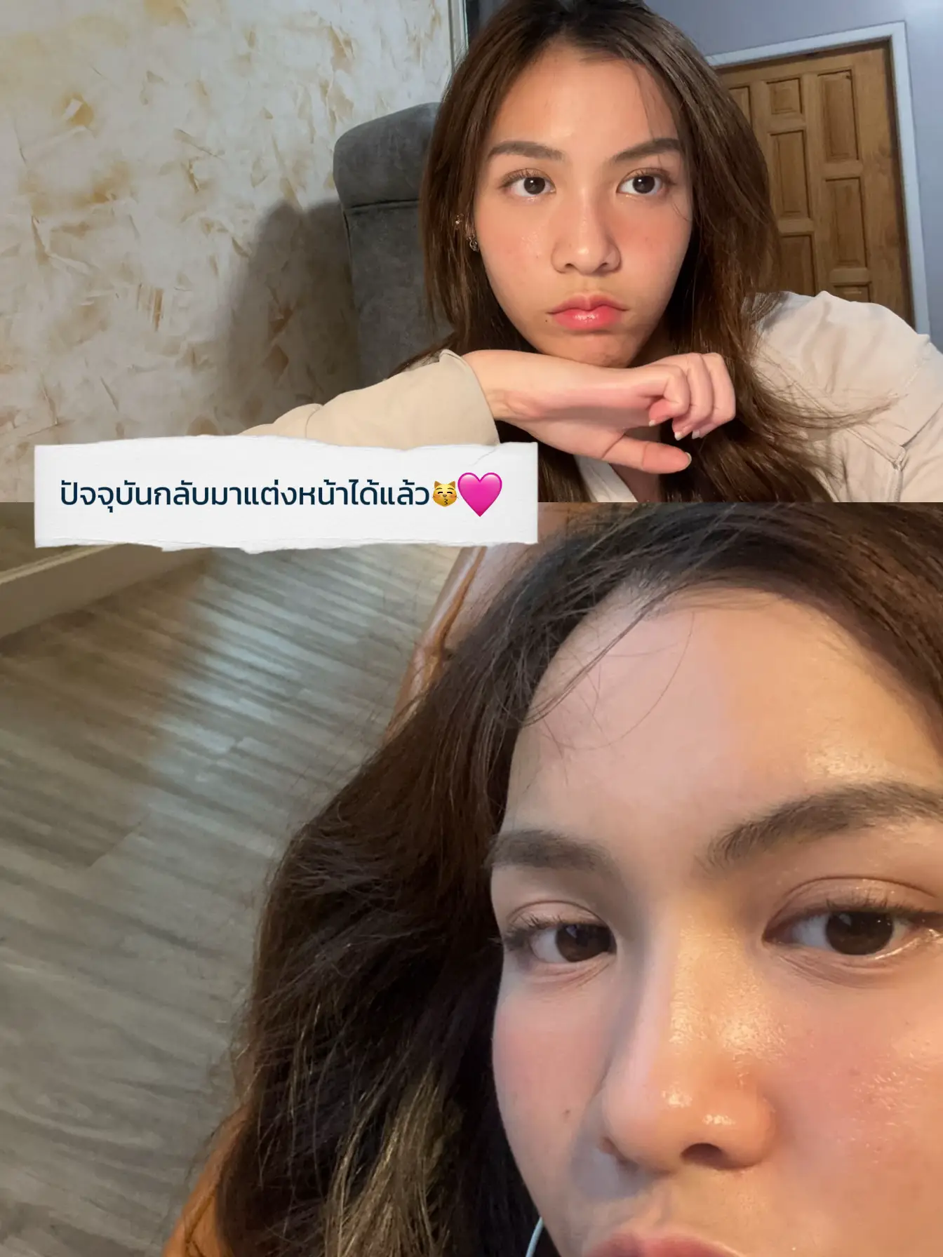 รีวิวรักษาสิว 5 เดือน ฉบับรักษากับคลินิก @คลินิกผิว | แกลเลอรีที่โพสต์โดย Geegee | Lemon8