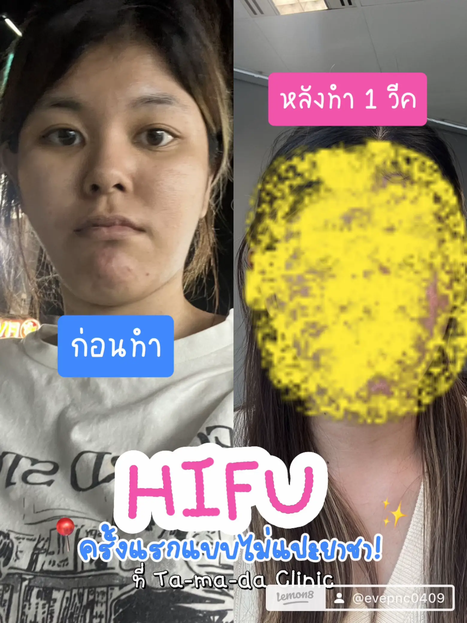 💥 HIFU ครั้งแรกแบบไม่แปะยาชา ผลลัพธ์ 1 วีคจะเป็นไง? | แกลเลอรีที่โพสต์โดย Eve Pnc | Lemon8
