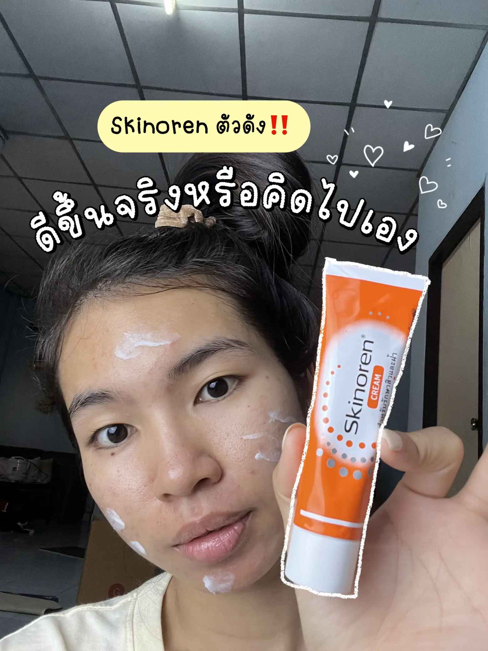 ดีขึ้นจริงหรือคิดไปเอง skinoren ลองตามหมออ้น TT | แกลเลอรีที่โพสต์โดย ...
