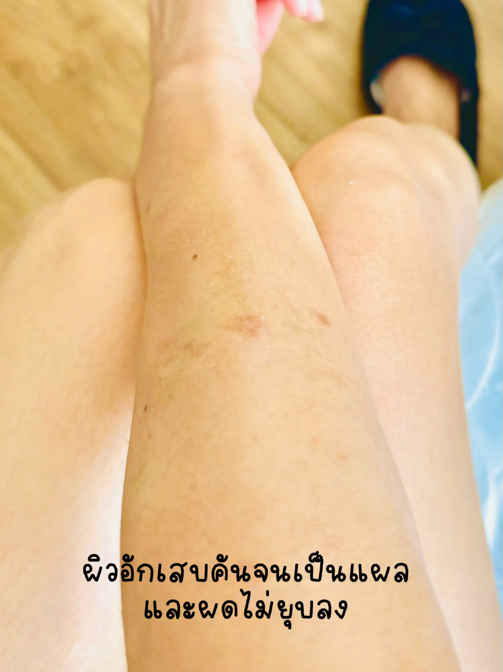 ภูมิแพ้ ผิวหนังอักเสบ ในวัย34 | แกลเลอรีที่โพสต์โดย Ployz | Lemon8