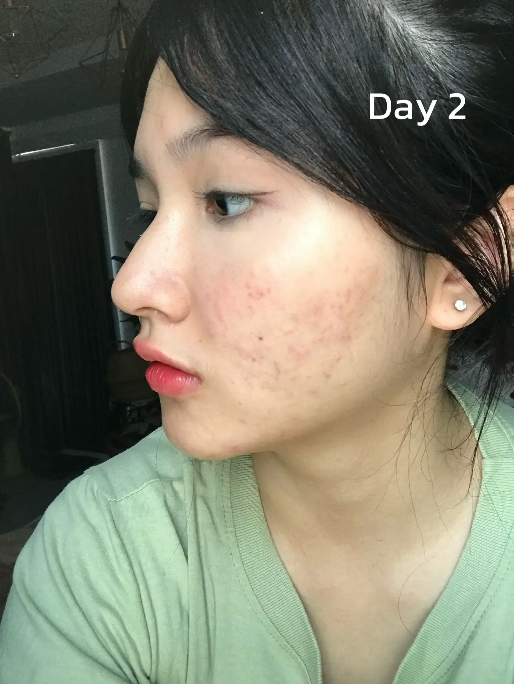 รีวิว Pico laser แบบพลีชีพ!! | แกลเลอรีที่โพสต์โดย nws_pancake | Lemon8