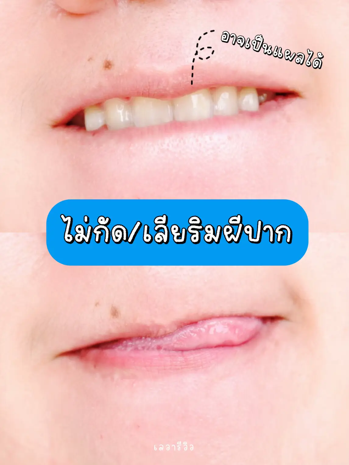 ดูแลช่องปากถูกวิธี - การค้นหาใน Lemon8