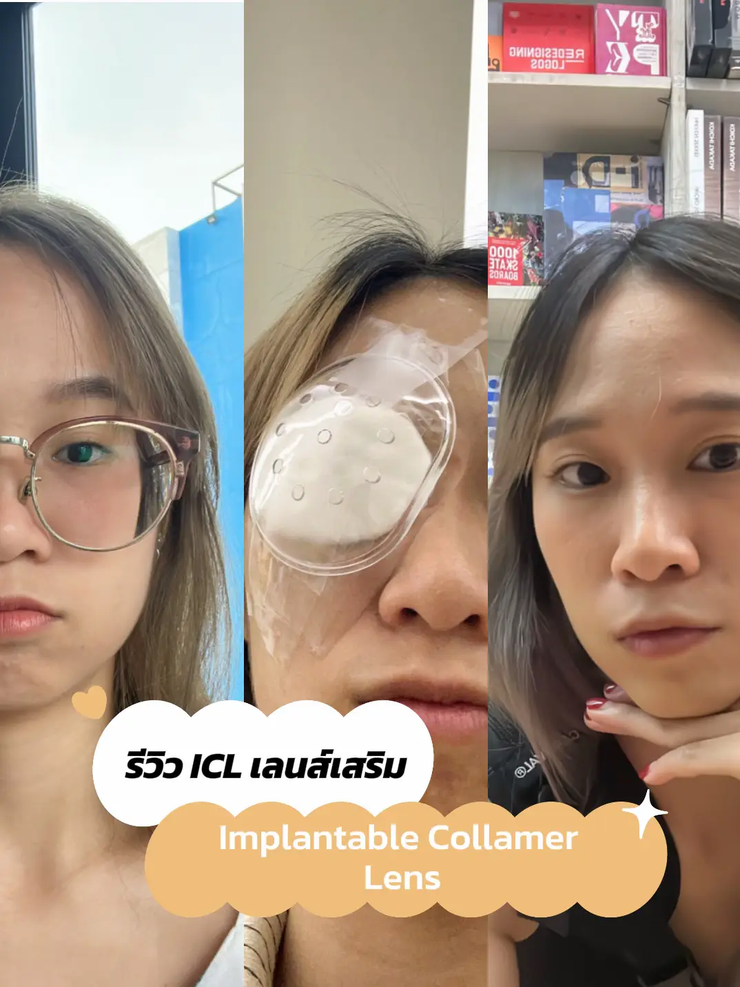 รีวิว ICL เลนส์เสริม | แกลเลอรีที่โพสต์โดย Toey Sasiwimon | Lemon8