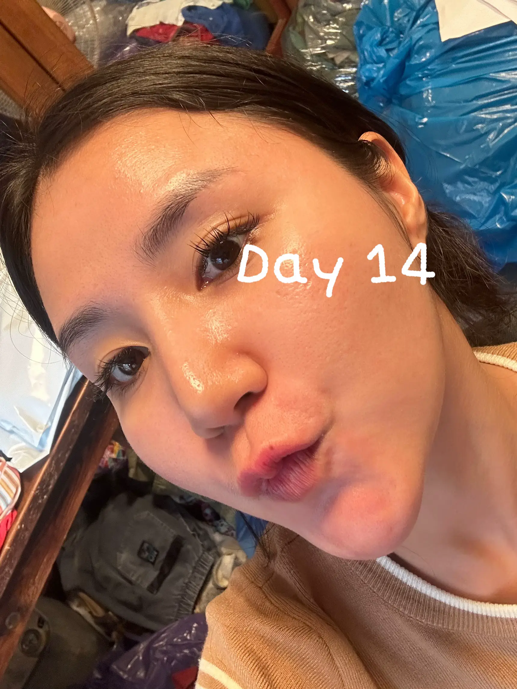 APDATE Fraxel laser 3rd | แกลเลอรีที่โพสต์โดย Kaowsrt | Lemon8