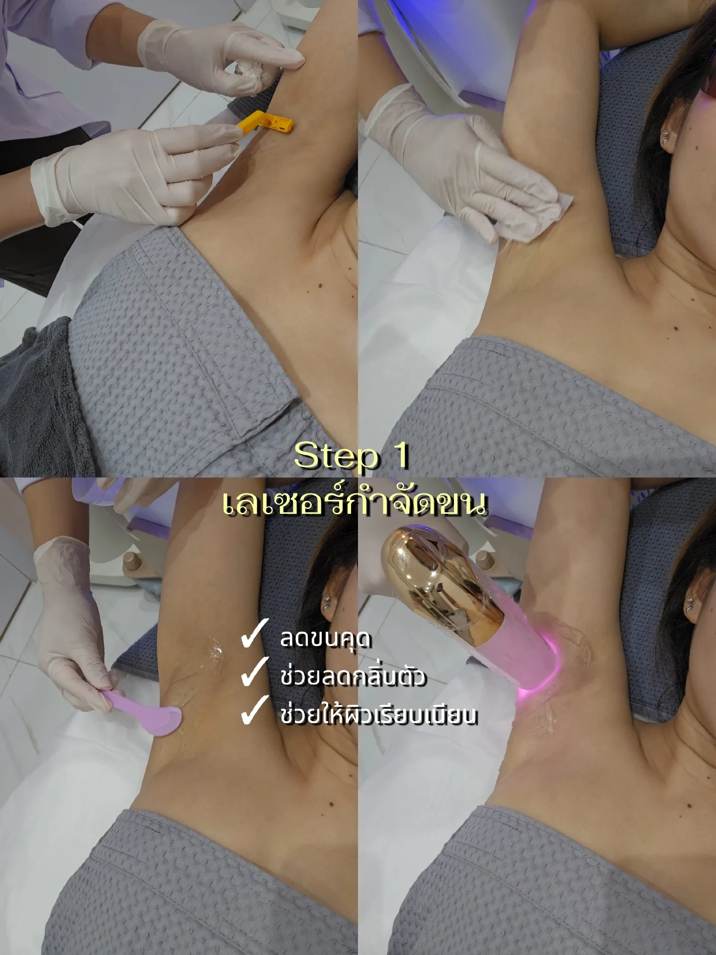 แชร์ประสบการณ์แพ้โรลออน รักแร้ดำมา 17 ปี | แกลเลอรีที่โพสต์โดย Kesinee.K | Lemon8