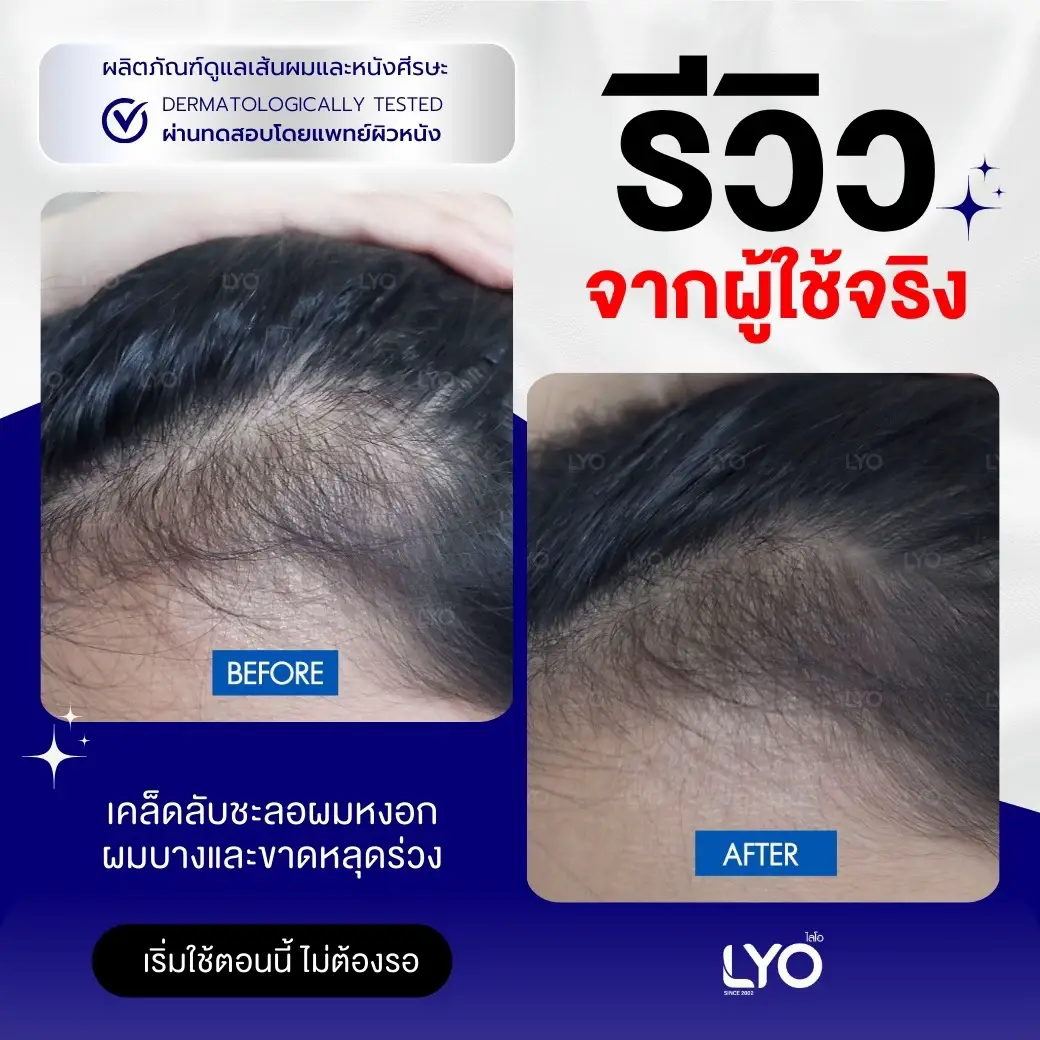 รีวิวจากผู้ใช้จริง Lyo Hair Tonic พิสูจน์มาแล้วว่าได้ผลจริง! | แกลเลอรีที่โพสต์โดย Step Healthy🌱 ...