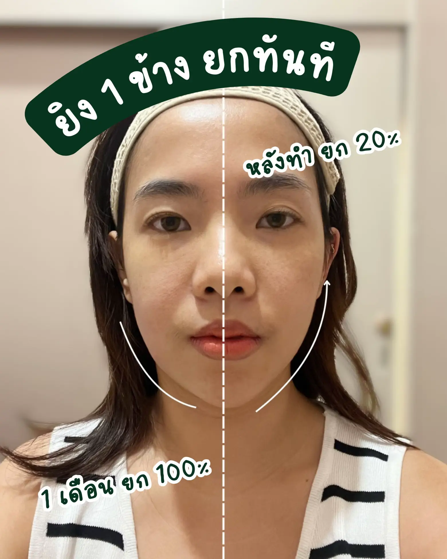 รีวิว Ultramax Hifu - การค้นหาใน Lemon8