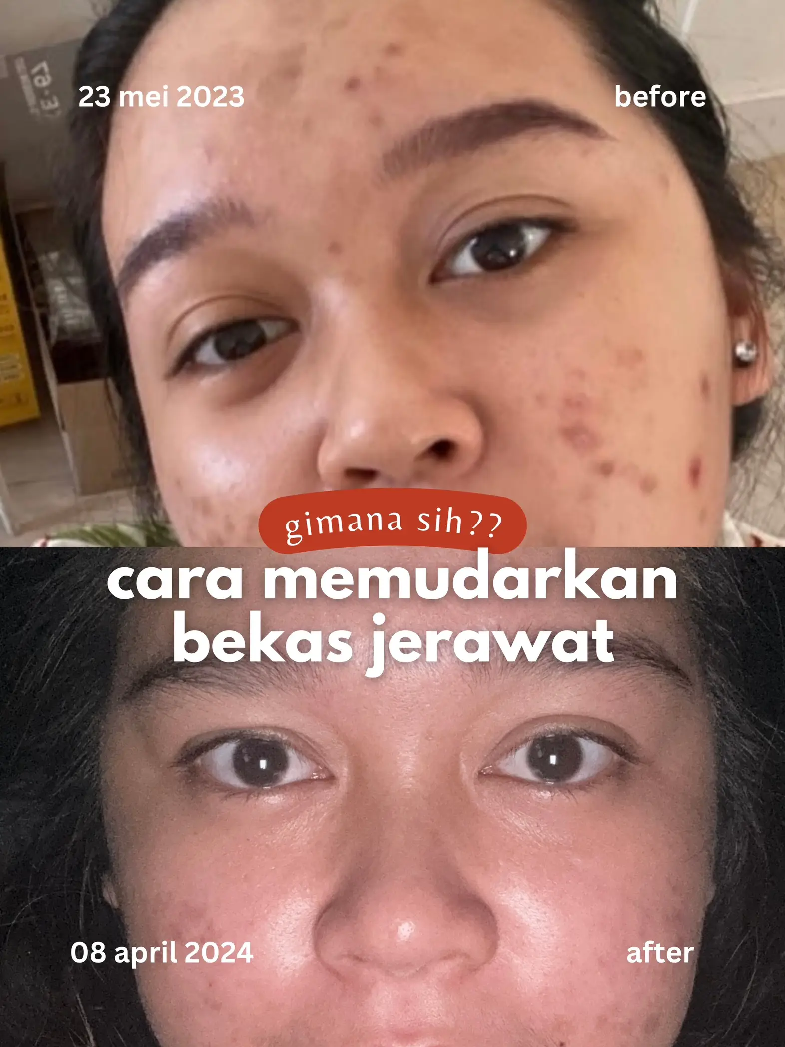 CARA MENGHILANGKAN BEKAS JERAWAT | Galeri diposting oleh tata🐰 | Lemon8