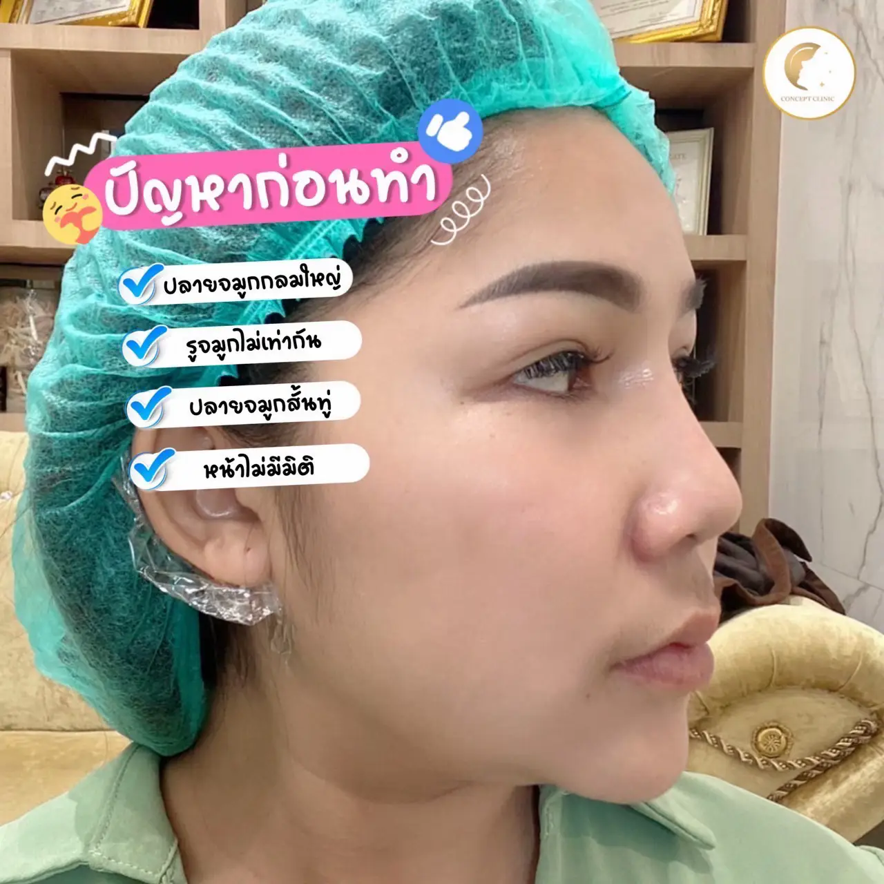 รีวิวพลีชีพ เเก้จมูกโอเพ่นแบบเรียลๆ | แกลเลอรีที่โพสต์โดย Conceptclinic | Lemon8