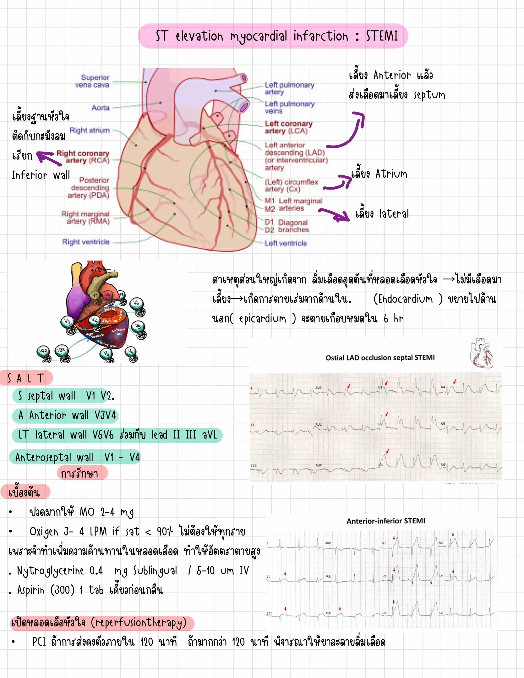 STEMI : ST elevation myocardia | แกลเลอรีที่โพสต์โดย Nurse ER | Lemon8