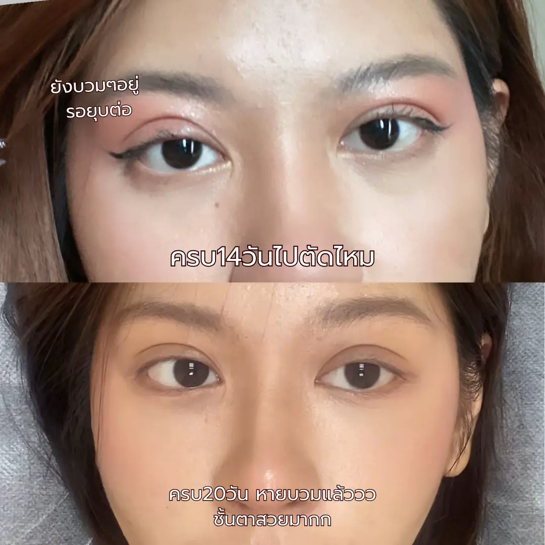 ศัลยกรรมครั้งแรกก็เปลี่ยนชีวิตเลย!! | แกลเลอรีที่โพสต์โดย ploysai.jpeg | Lemon8