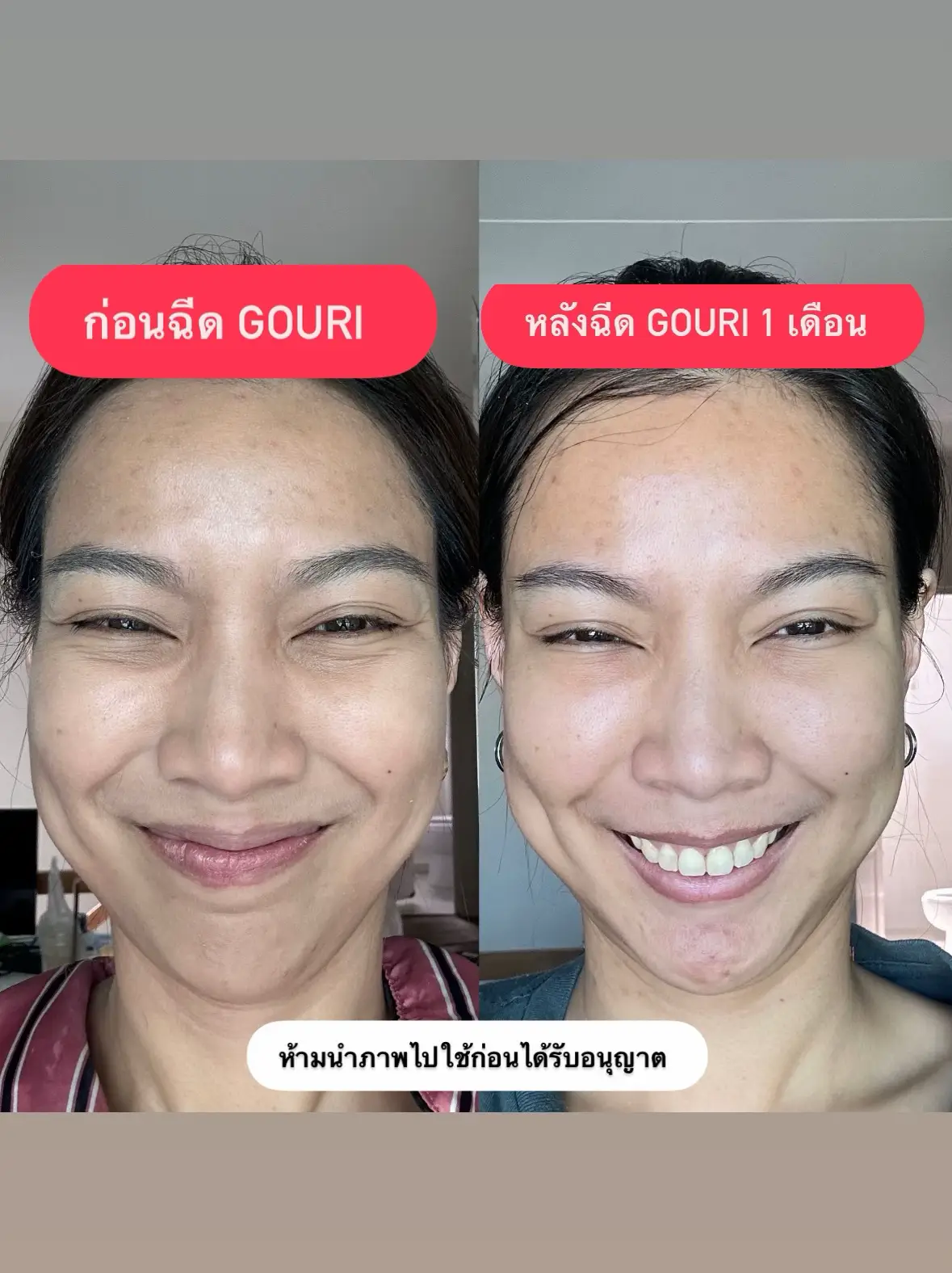 (No sponsored) First Undereye Gouri Injection Review Complete 1 Month ...