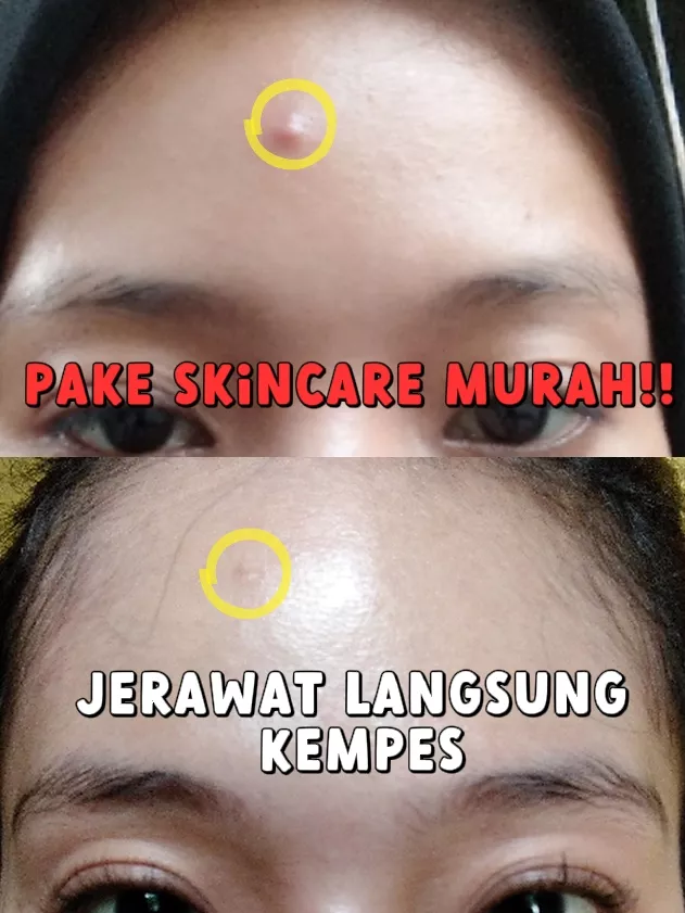 JERAWAT dan Bekas Jerawat Hilang | Galeri diposting oleh muty | Lemon8