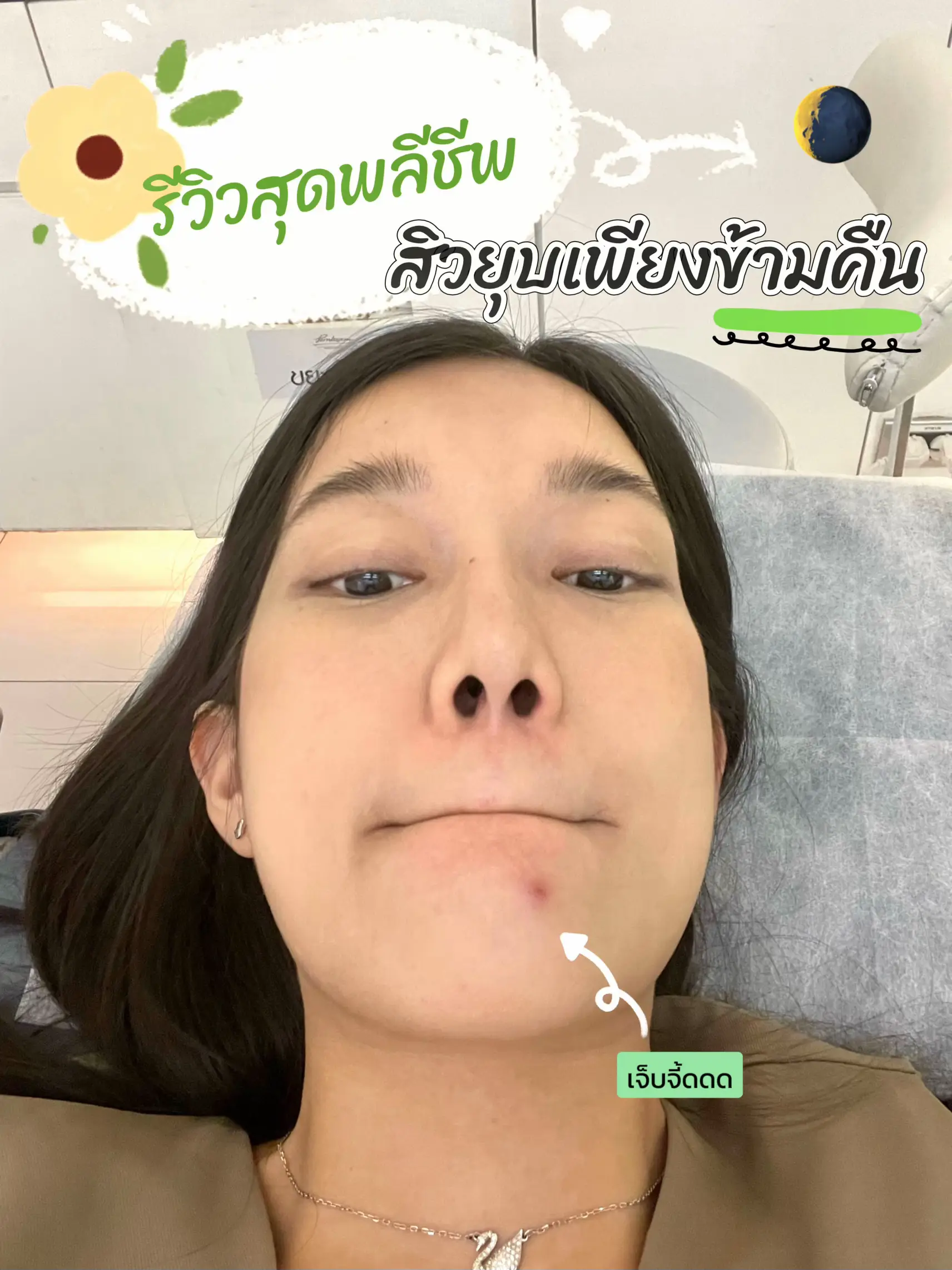 🍋รักษารอยสิวด้วย ADVA Light Program กับ พรเกษมคลินิก | วิดีโอที่เผยแพร่โดย 🧚Jenjira 246💃 | Lemon8