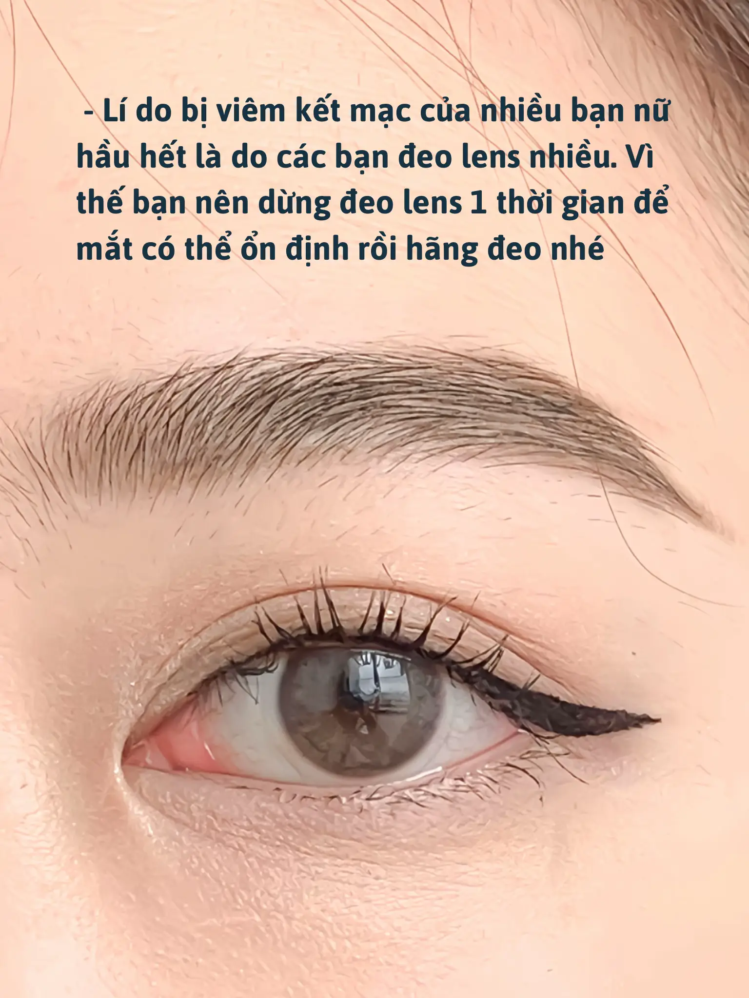 Cách xử lí viêm kết mạc khi đeo lens 🥺 | Bộ sưu tập do Hà Vy Xinh đăng | Lemon8